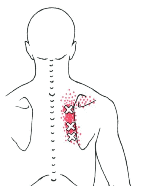 Rhomboids Trigger points - Complete Calm Massage Therapy